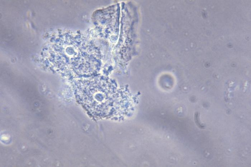 pengertian CANDIDIASIS VAGINALIS